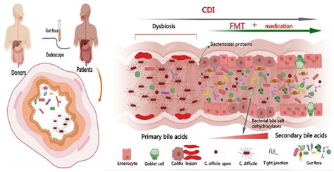 C Diff Bacterial Infection Symptoms Inflammatory Bowel Disease And