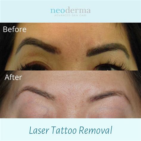 Picosure Eyebrow Tattoos Cosmetic Tattoo Removal — Hoi Skyns