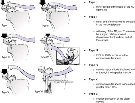 The Acromioclavicular Joint Anatomy Injury Pathoanatomy And