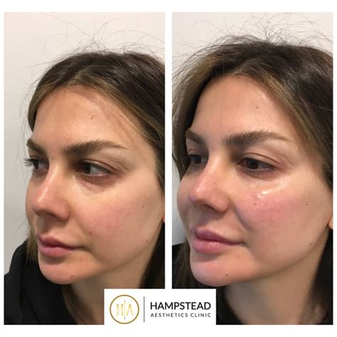 How Long Masseter Botox Takes To Work Results Timeline And What To Expect