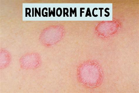Ringworm Facts And Faqs