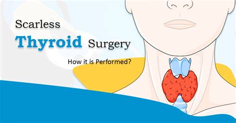Endoscopic Thyroidectomy Scarless Thyroid Surgery