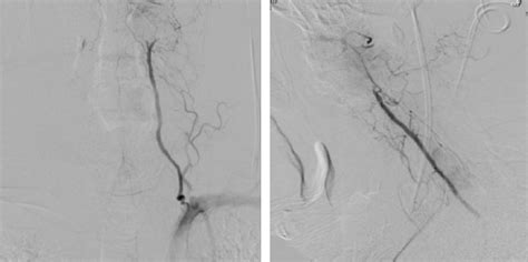 Endovascular Right Vertebral Artery Compression Syndrome