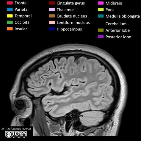 Brain Lobes Annotated Mri Radiopaedia 61691 69700 Sagittal Nc Commons