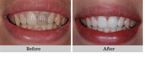 Chemical Bleaching Teeth At Harry Goodwin Blog
