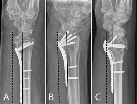 Lateral Radiographs Demonstrating Assessment Using The Soong Download Scientific Diagram