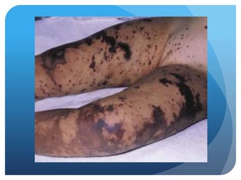 Paediatric Septic Shock Is A Very Sever And Dangerous For Pediatric Pptx