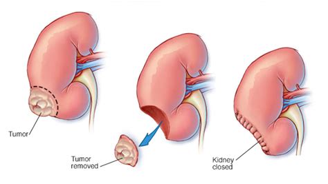 Laparoscopic Partial Nephrectomy Mkm Hospital