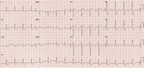 Right Bundle Branch Block Rbbb • Litfl • Ecg Library Diagnosis