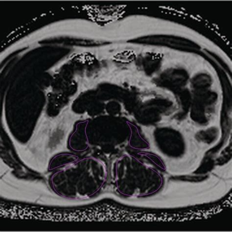 Paravertebral Muscle Segmentation At The Level Of The Third Lumbar