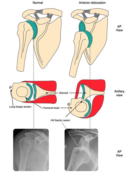Shoulder Dislocation Orthosho