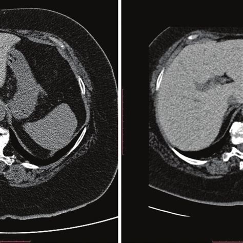Increased Hepatic Attenuation At First And Second CT Examination Download Scientific Diagram
