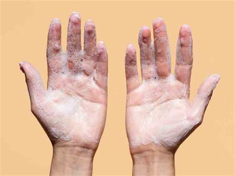 Fungal Infection Hands Ears