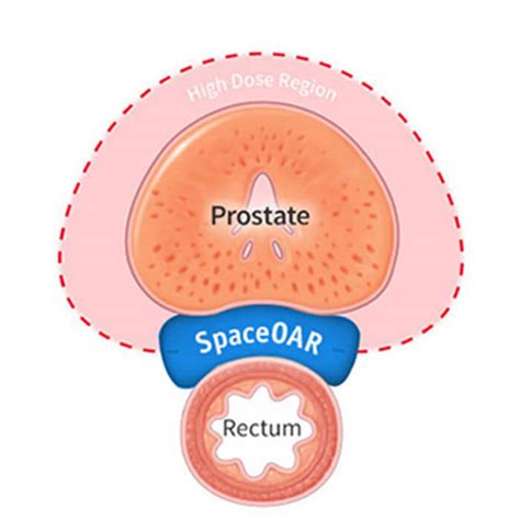 Spaceoar™ Hydrogel Prostate Cancer Hydrogel Spacer