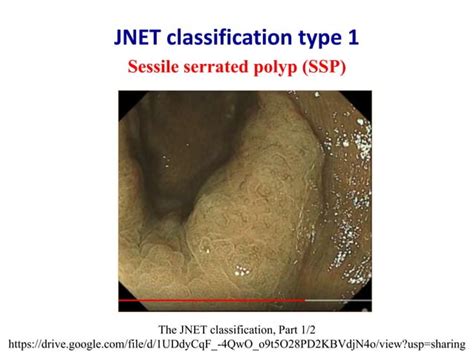 Jnet Classification Of Colo Rectal Polyps Pptx Medical Health