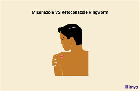 Miconazole Vs Ketoconazole For Ringworms Managing Ringworm Knya