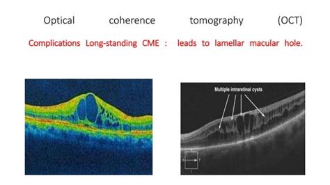 Cscr Central Serous Chorioretinopathy Pptx Eye And Vision