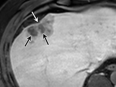 Intrahepatic Mass Forming Cholangiocarcinoma Arterial Enhancement