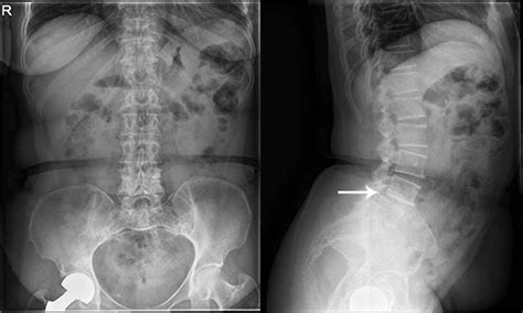 Lumbar Spinal Canal Osteosarcoma A Case Report Medicine