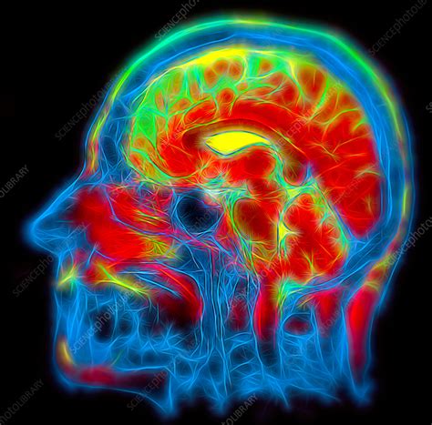 Healthy Head And Brain Mri Scan Stock Image C0573475 Science