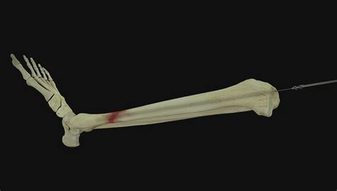 Tibia Orif Right Side White Male Annotated 1080p 100189
