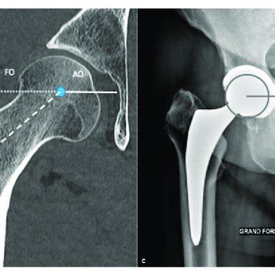 Preoperative Measurements Those Values Can Be Measured On A An Download Scientific Diagram