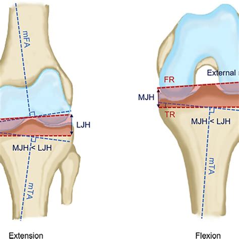 Illustration Of The Arka Technique The Tibial Cutting Guide Was