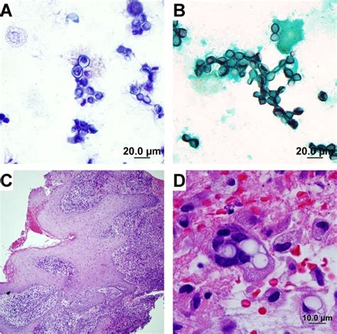 Cutaneous Blastomycosis Masquerading As Pyoderma Gangrenosum Pmc