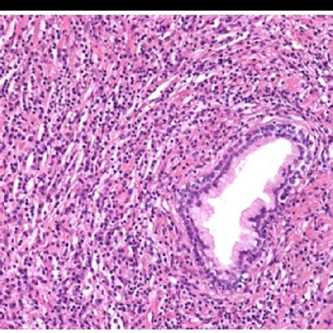 Fibrosis Has A Characteristic Storiform Pattern Typified By A Download Scientific Diagram