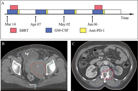 A The Patients Treatment Schedule For 4 Cycles Subcutaneous