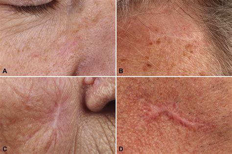 References In Aesthetic Outcome And Complications Of Simple Interrupted