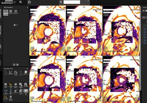 Live View Of The Inline Quantitative Perfusion Map From The Scanner Download Scientific
