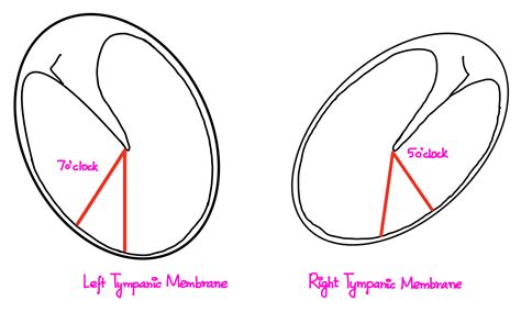How To Draw A Normal Tympanic Membrane Ent Notes And Lectures