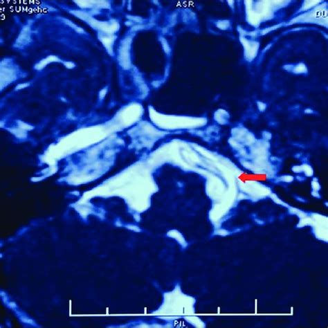 Pdf Vascular Loop Of Anterior Inferior Cerebellar Artery Causing Disabling Tinnitus Vertigo