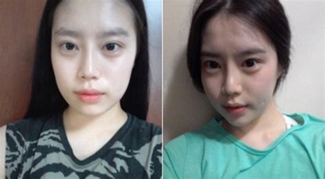 Minjis Plastic Surgery Real Review Banobagi Korean Plastic Surgery
