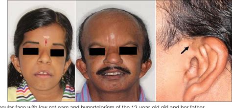 Figure 1 From Clinical Spectrum Of Silver Russell Syndrome Semantic