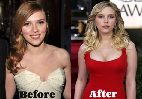 Scarlett Johansson Breast Enlargement