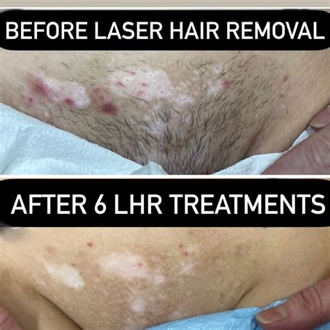 Laser Hair Removal Before And After Brazilian