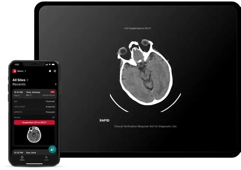 Rapidai Stroke Imaging Solutions Advanced Ai For Ischemic Stroke