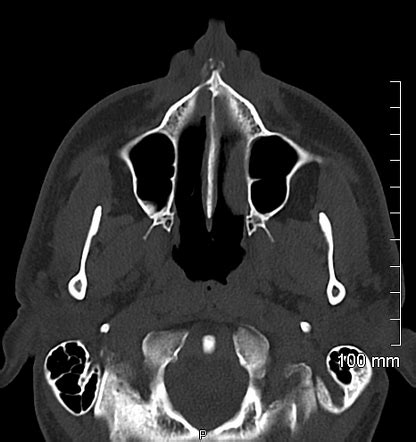 Anterior Nasal Spine Panoramic