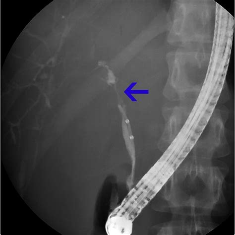 Treatment Of A Dominant Stricture In A Patient With Psc Description