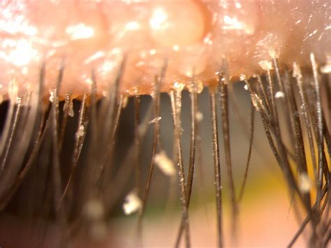 Blepharitis Scope Connect