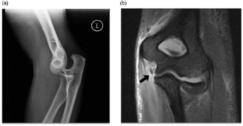 Elbow Dislocation Classification