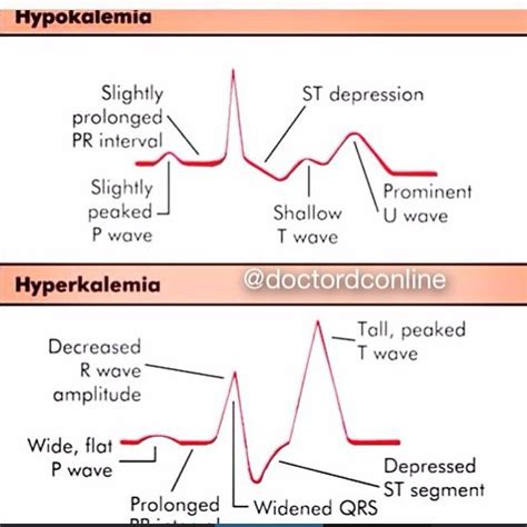 Doctor Doctordconline Hypokalemia Vs H Instagram Hyperkalemia Medical School Stuff