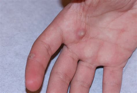 What Are Warts And Wart Treatments Contour Dermatology