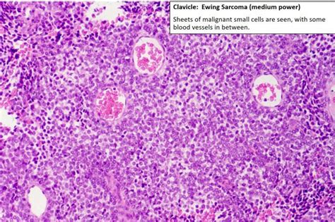 Clavicle Ewings Sarcoma Nus Pathweb Nus Pathweb