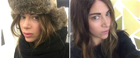 Do Lip Injections Damage Lips An Experts Perspective