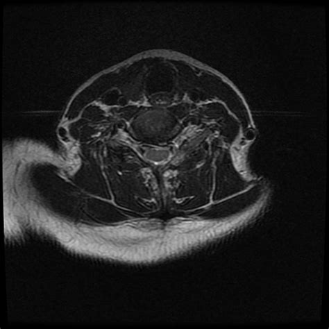 Neck And Back Arizona Prolotherapy