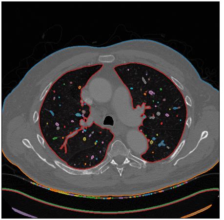 Introduction To Medical Image Processing With Python CT Lung And