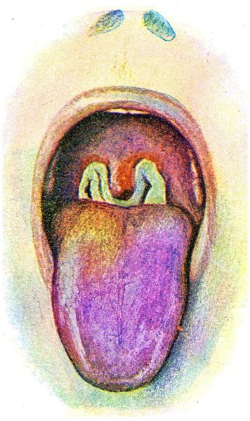 Diphtheria Membrane Over 10 Royalty Free Licensable Stock